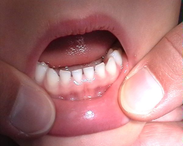 Japanese Scientists Begin Human Trials for Revolutionary Tooth Regrowth ...